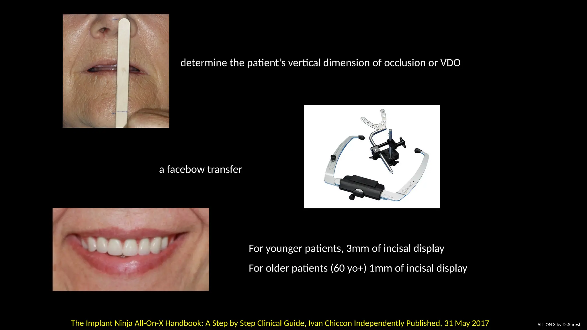 ALL On X / All on 4 /All on 6 Concepts.pptx