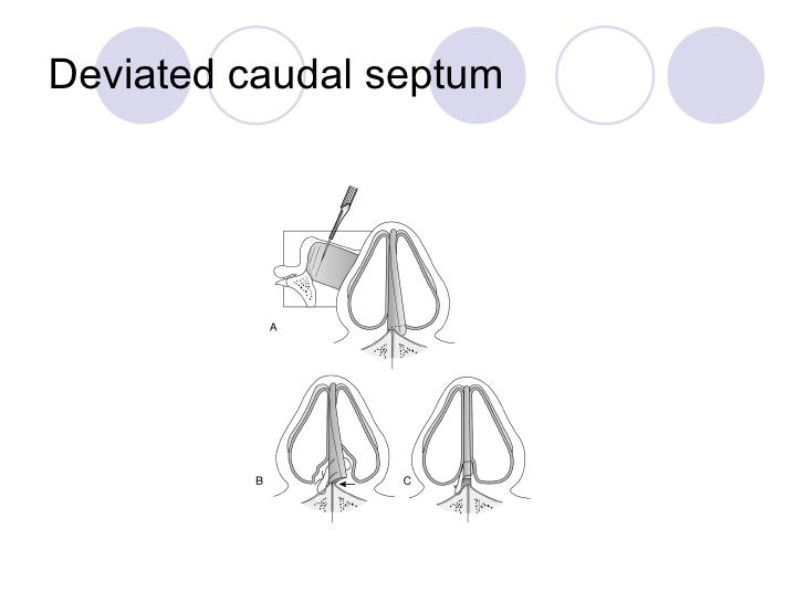 All Things Septoplasty