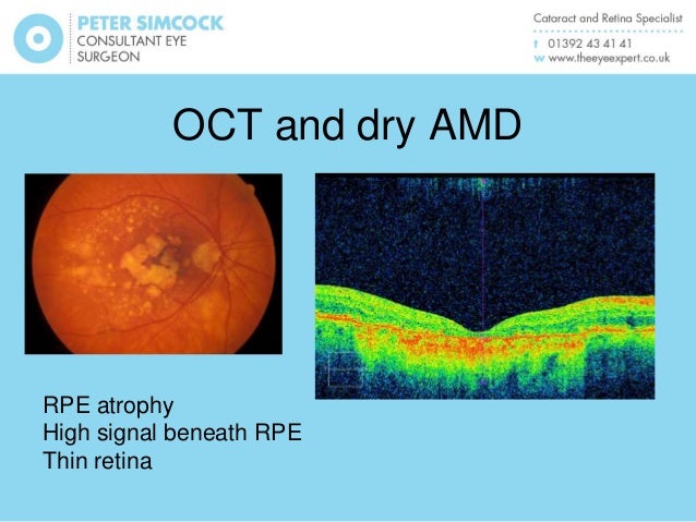 All you need to know about amd and the oct but were afraid to ask