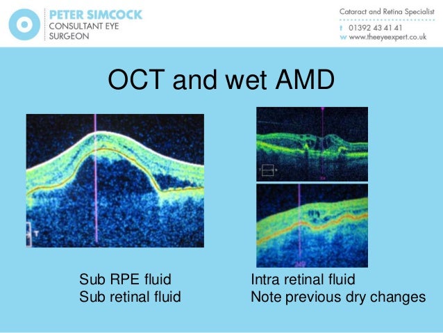 All you need to know about amd and the oct but were afraid to ask