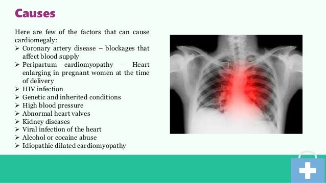 All You Need To Know About Cardiomegaly