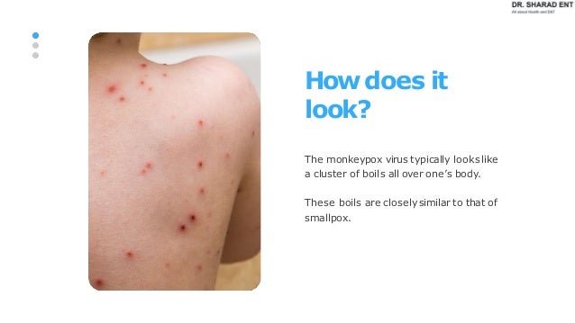 All You Need To Know About Money Pox Virus | Dr. Sharad ENT | PPTX