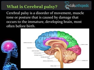 All you want to know about cerebral palsy | PPT