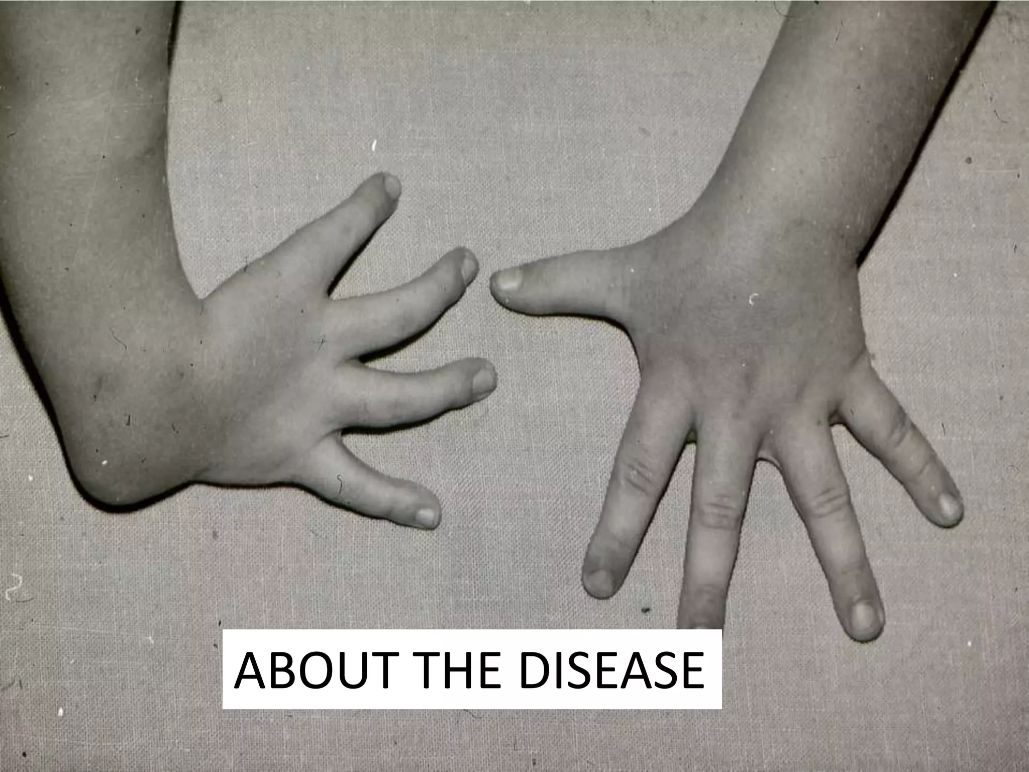 All you want to know about radial dysplasia | PPTX