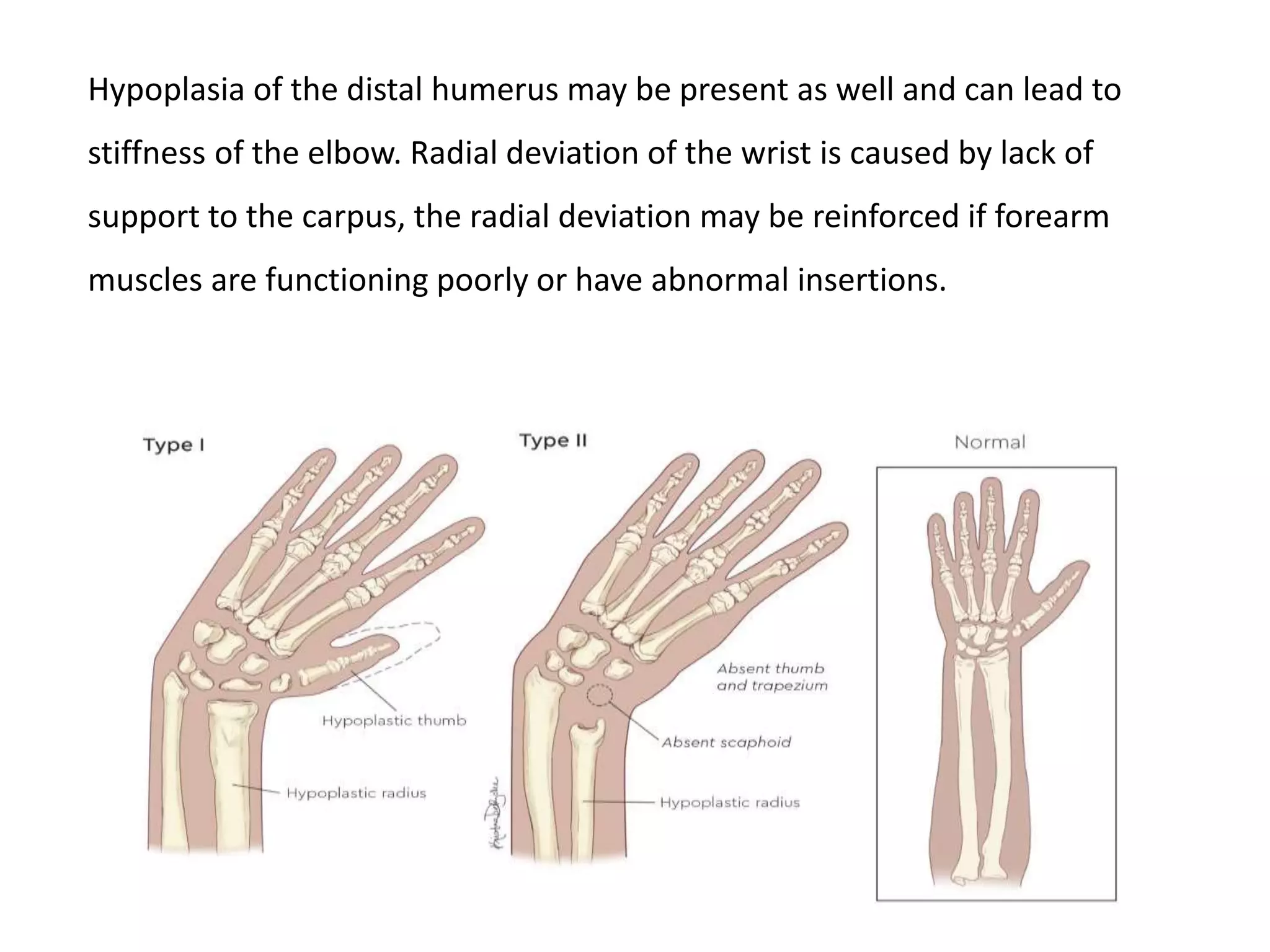 All you want to know about radial dysplasia | PPTX