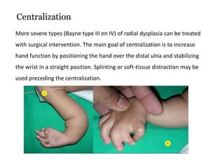 All you want to know about radial dysplasia | PPTX