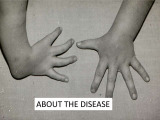 All you want to know about radial dysplasia | PPTX