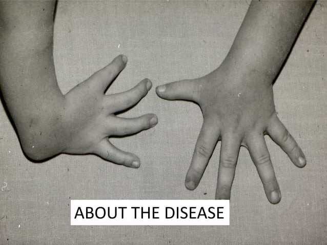 All you want to know about radial dysplasia | PPTX | Death, Injury, or ...