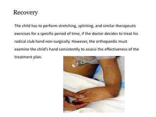 All you want to know about radial dysplasia | PPTX