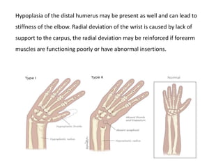 All you want to know about radial dysplasia | PPTX