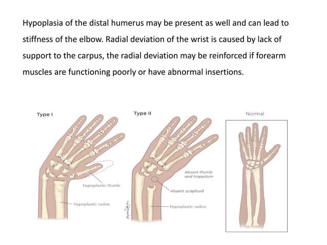 All you want to know about radial dysplasia | PPTX | Death, Injury, or ...
