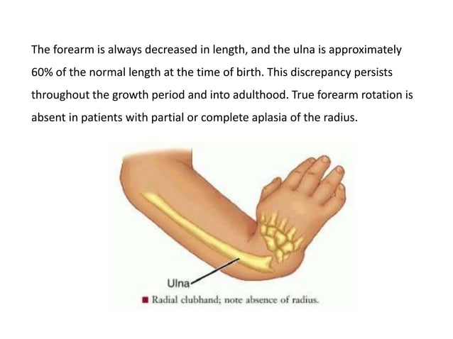 All you want to know about radial dysplasia | PPTX | Death, Injury, or ...