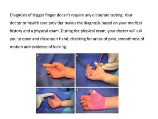 All you want to know about trigger finger by kids orthopedic | PPT