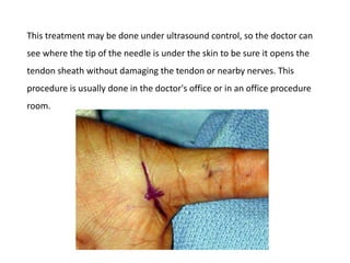 All you want to know about trigger finger by kids orthopedic | PPT