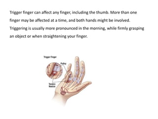 All you want to know about trigger finger by kids orthopedic | PPTX
