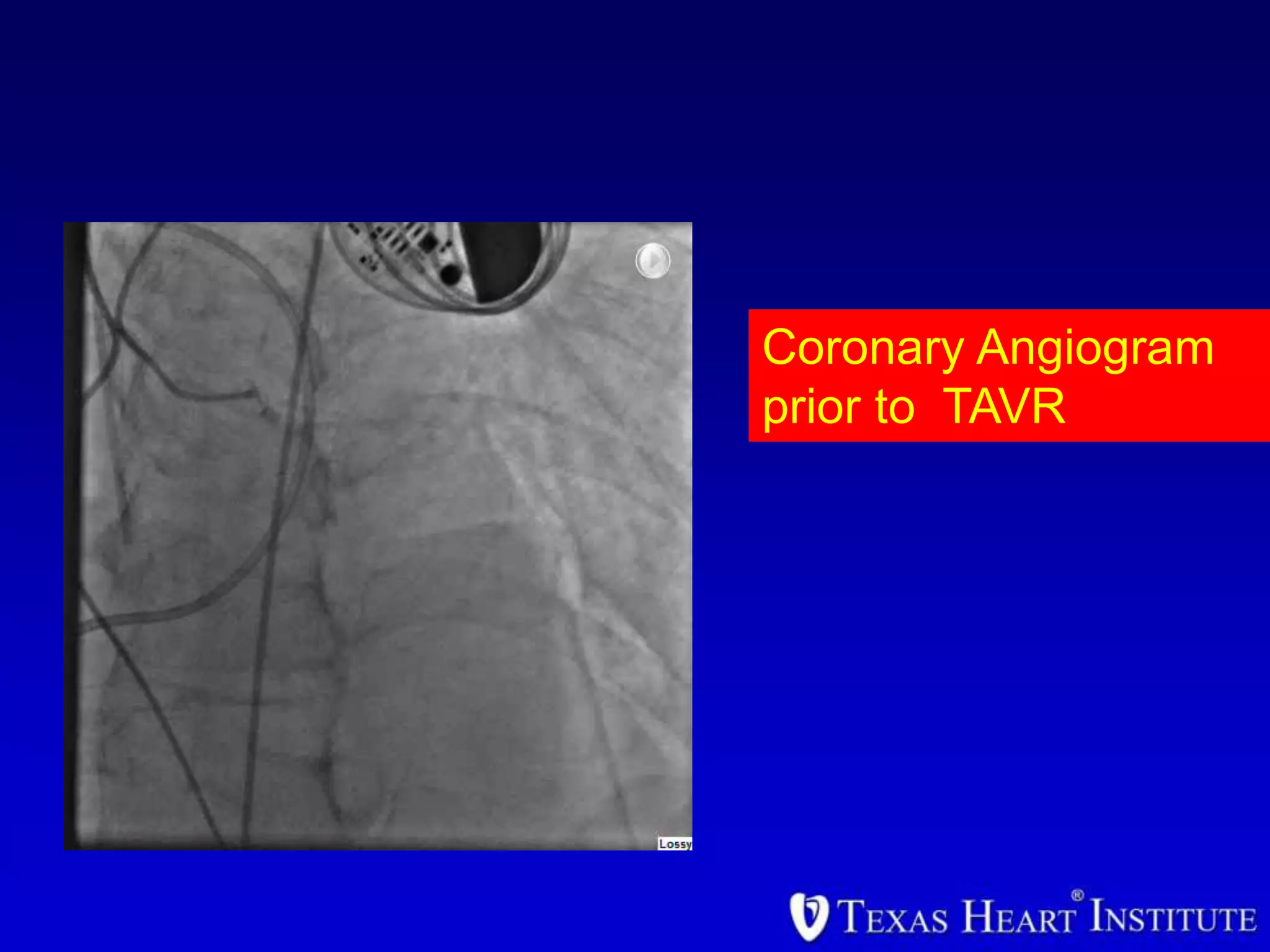 High Risk Left main PCI using Impella in post-TAVR patient | PPTX