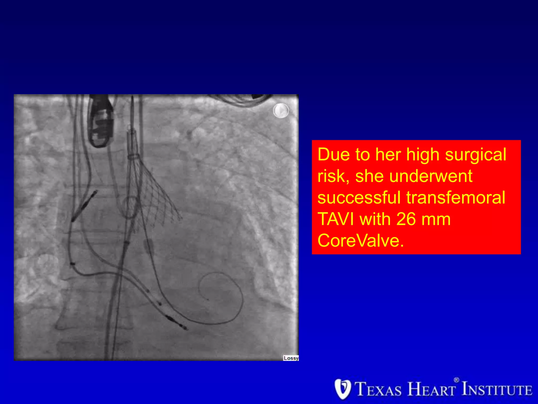 High Risk Left main PCI using Impella in post-TAVR patient | PPTX