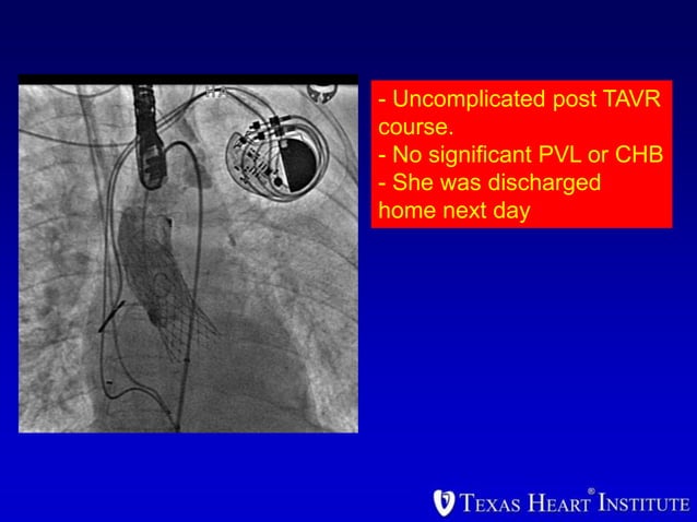 High Risk Left main PCI using Impella in post-TAVR patient | PPTX | Heart and Cardiovascular ...