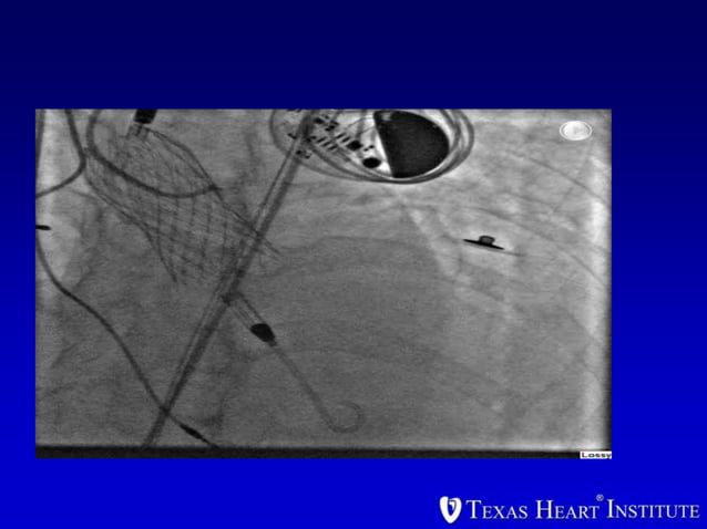 High Risk Left main PCI using Impella in post-TAVR patient | PPTX | Heart and Cardiovascular ...