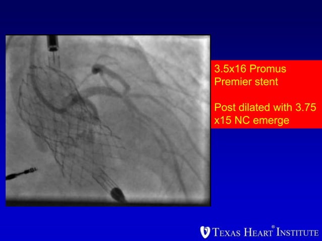 High Risk Left main PCI using Impella in post-TAVR patient | PPTX | Heart and Cardiovascular ...