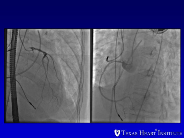 High Risk Left main PCI using Impella in post-TAVR patient | PPTX | Heart and Cardiovascular ...