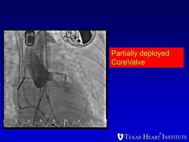 High Risk Left main PCI using Impella in post-TAVR patient | PPTX | Heart and Cardiovascular ...