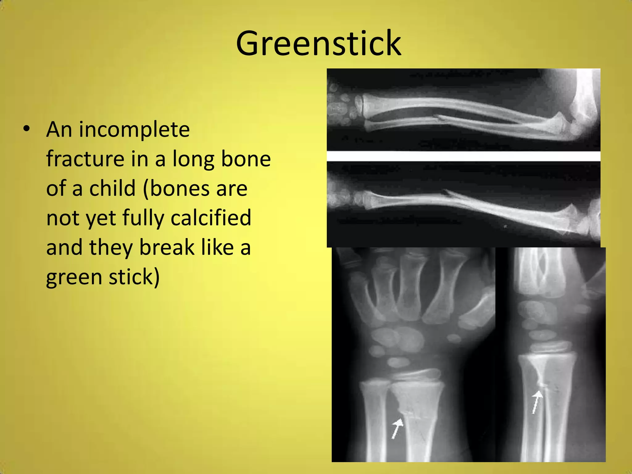 fracture and dislocation ppt . Almas khan. khorfakkhan hospital dubai ...