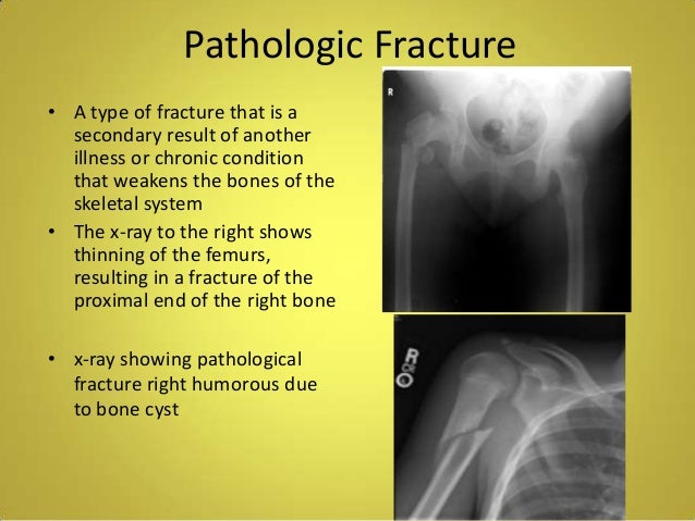 fracture and dislocation ppt . Almas khan. khorfakkhan hospital dubai