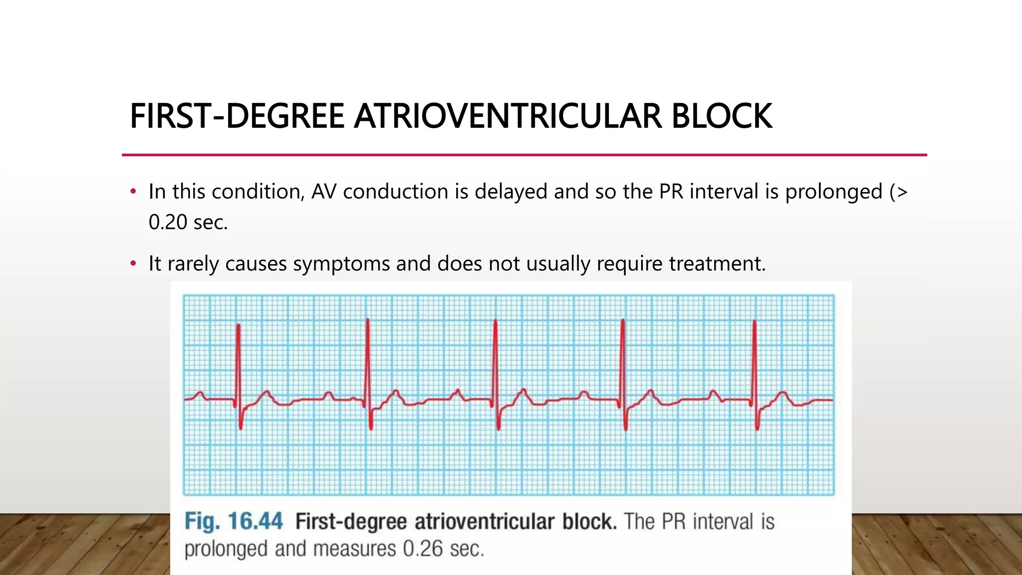 Alok Kumar (Grp 09) Sem 09 Types Of Heart Block.pptx | Heart and ...