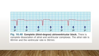 Alok Kumar (Grp 09) Sem 09 Types Of Heart Block.pptx | Heart and ...