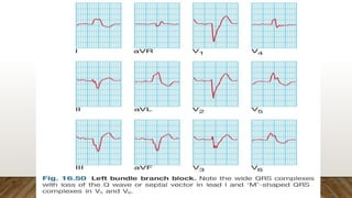 Alok Kumar (Grp 09) Sem 09 Types Of Heart Block.pptx