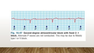 Alok Kumar (Grp 09) Sem 09 Types Of Heart Block.pptx | Heart and ...
