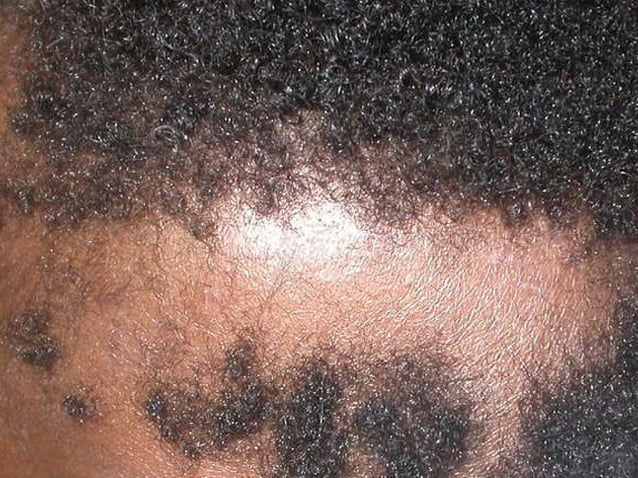 Alopecia. | PPT