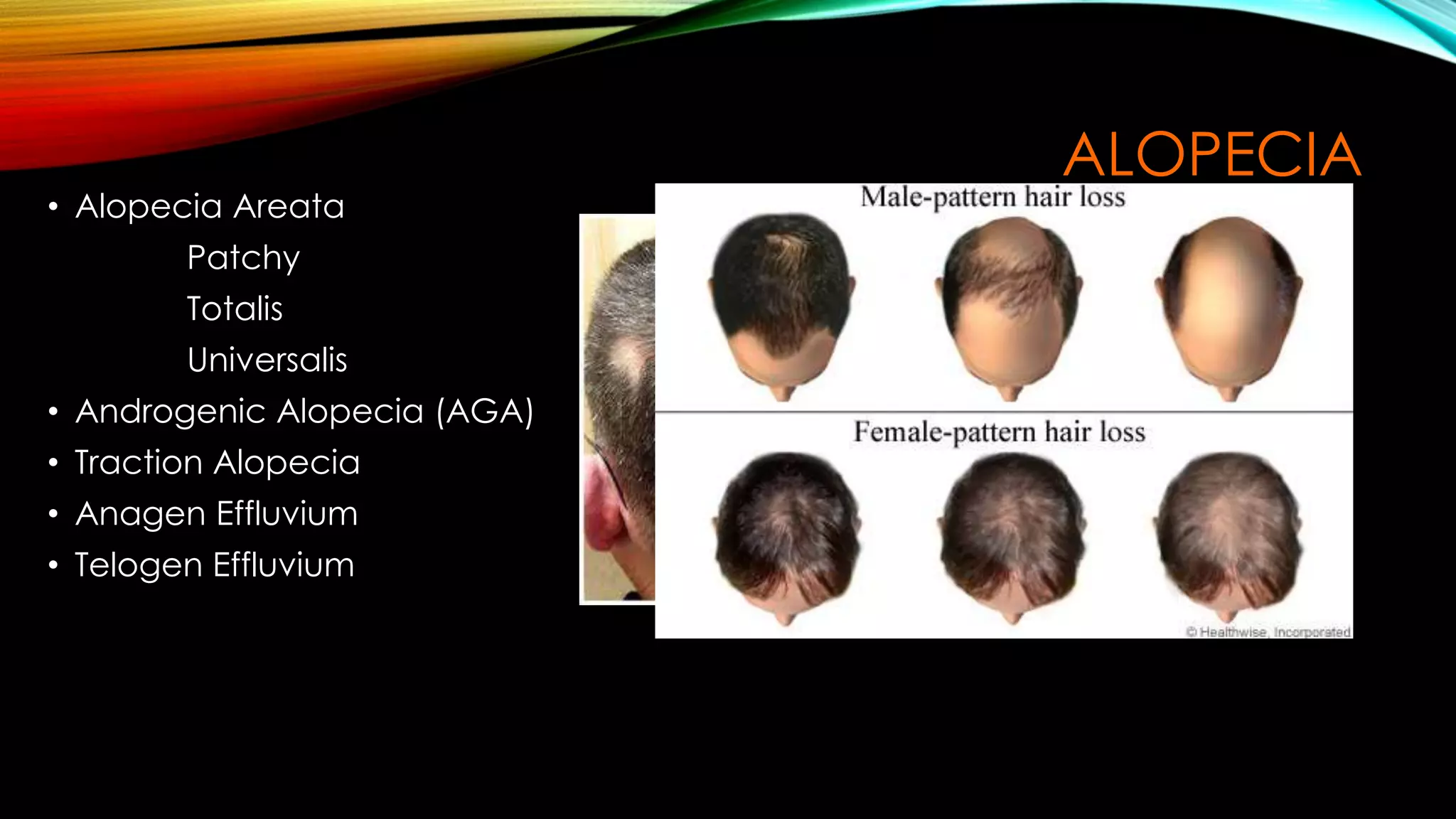 pharmacotherapy of alopecia & hirsutism | PPTX