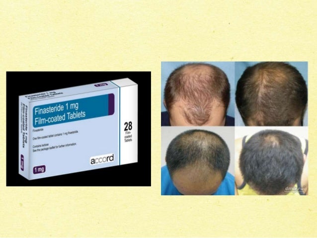 Alopecia 160716052003