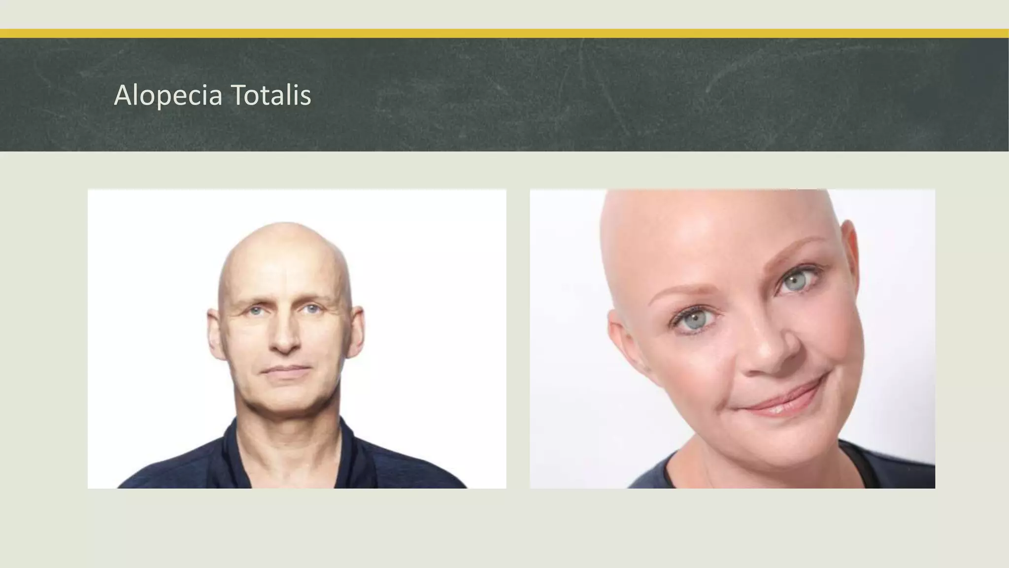 Alopecia - Types and causes | PPTX