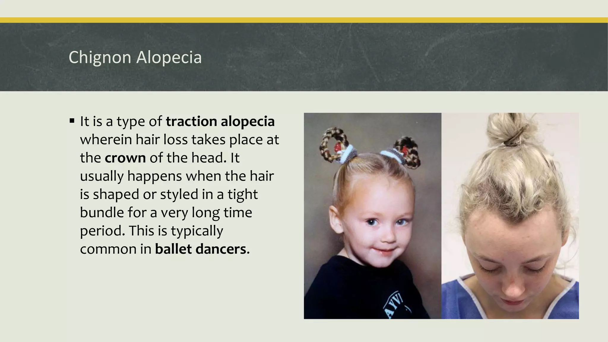 Alopecia - Types and causes | PPTX
