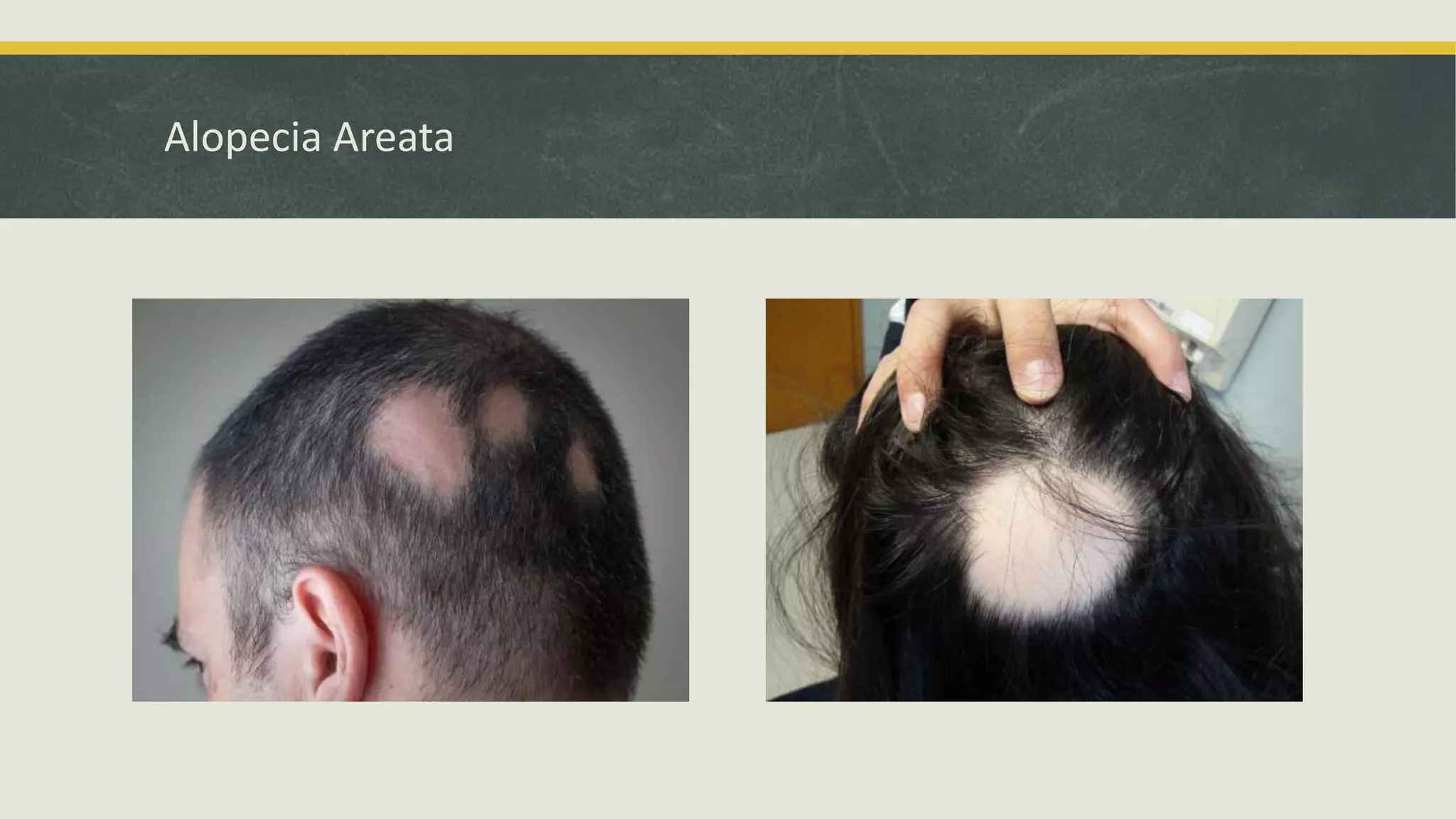 Alopecia - Types and causes | PPTX
