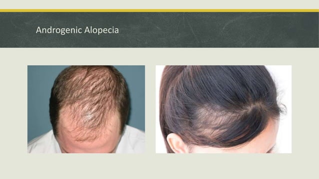 Alopecia - Types and causes | PPTX | Skin and Dermatology | Diseases ...