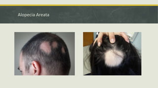 Alopecia - Types and causes | PPTX