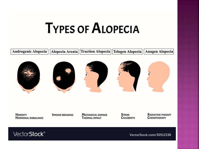 Alopecia.pptx | Skin and Dermatology | Diseases and Conditions