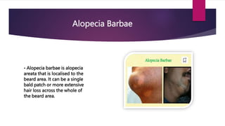 alopecia.pptx