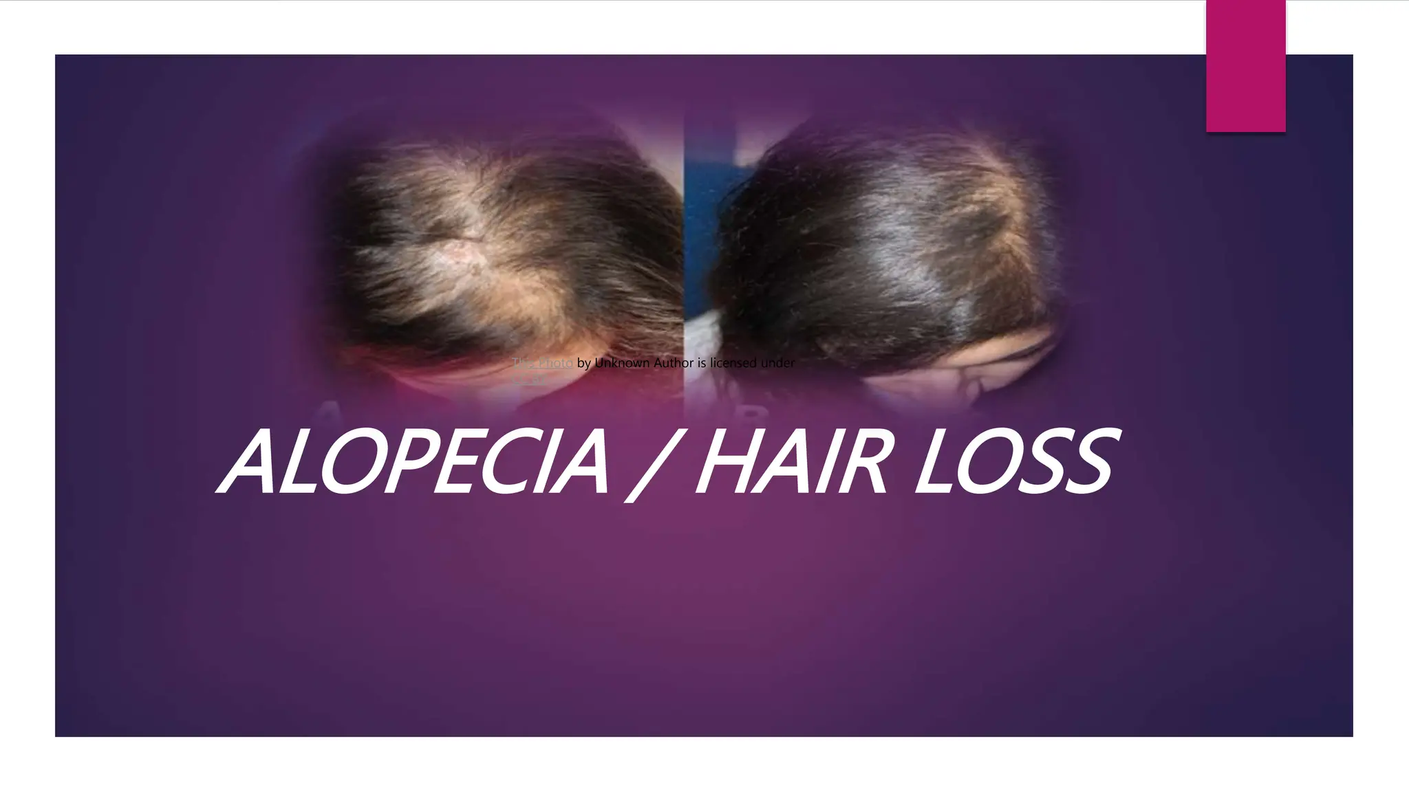 What is Alopecia/Hair loss and treatment.pptx