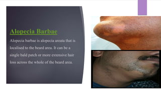 Alopecia of hair disorders with medication.pptx