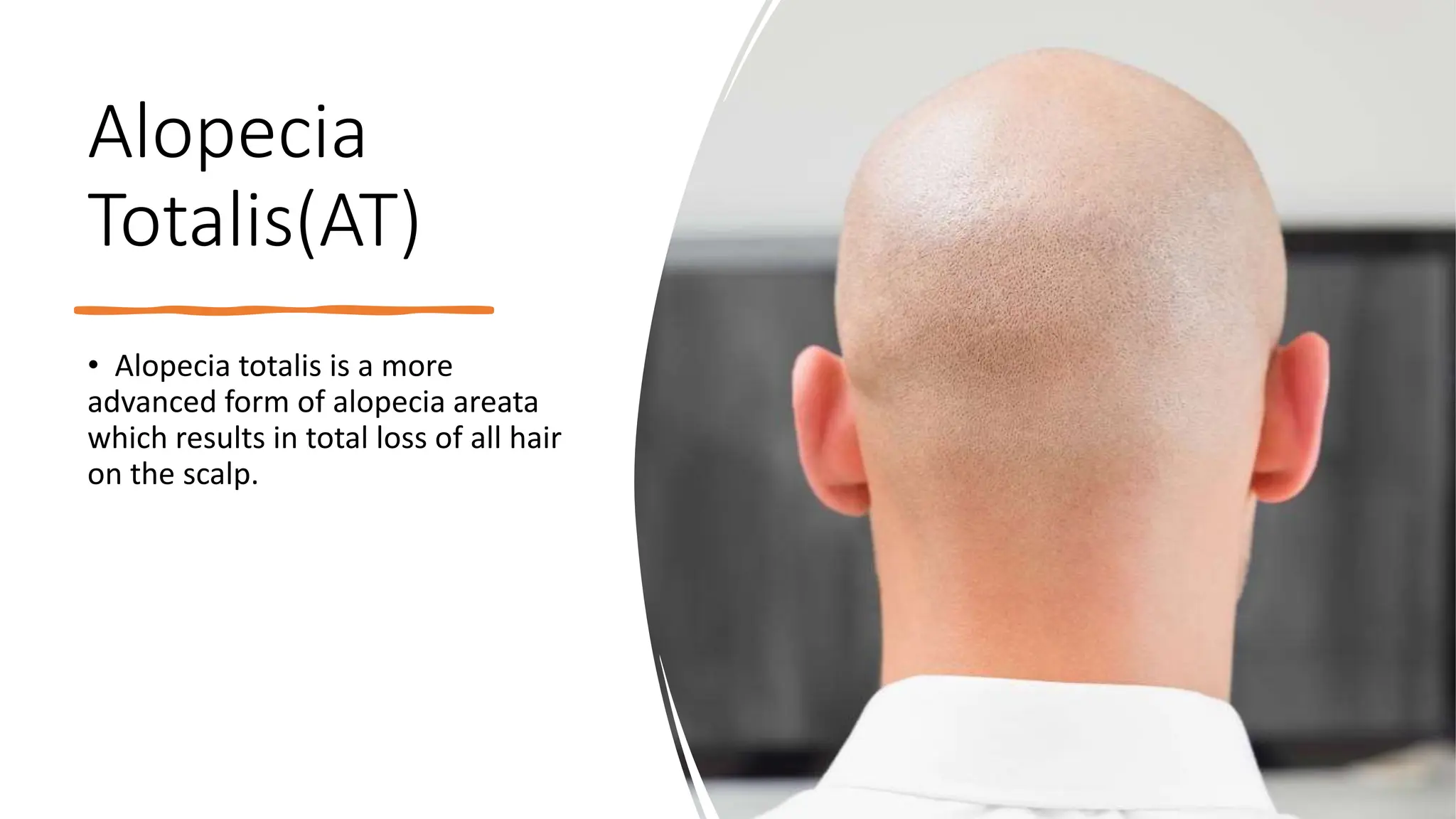 AlopeciaPresentation on Alopecia, dermatology .pptx