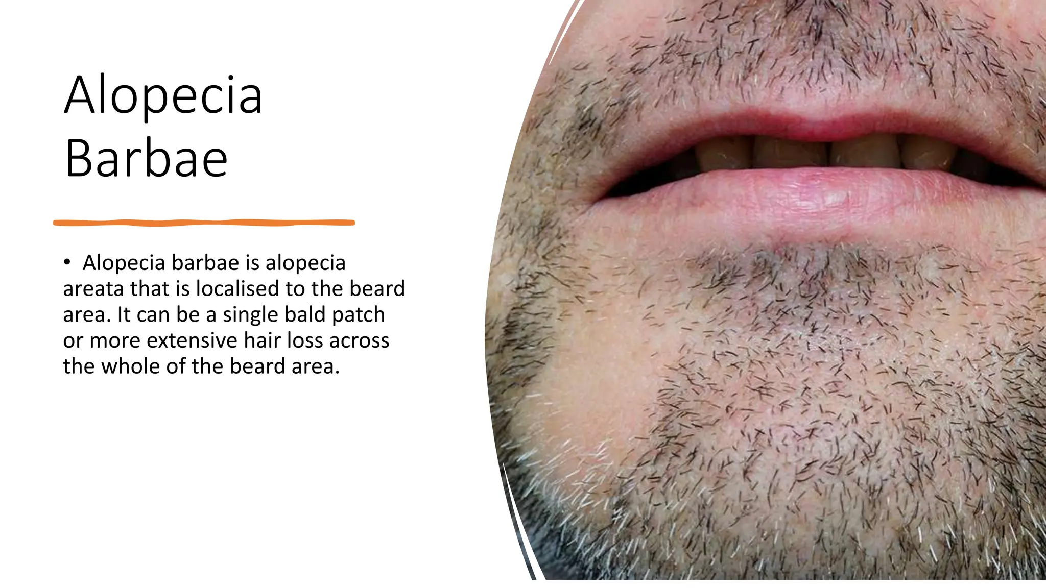 AlopeciaPresentation on Alopecia, dermatology .pptx