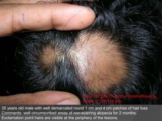 Alopecia areata | PPTX