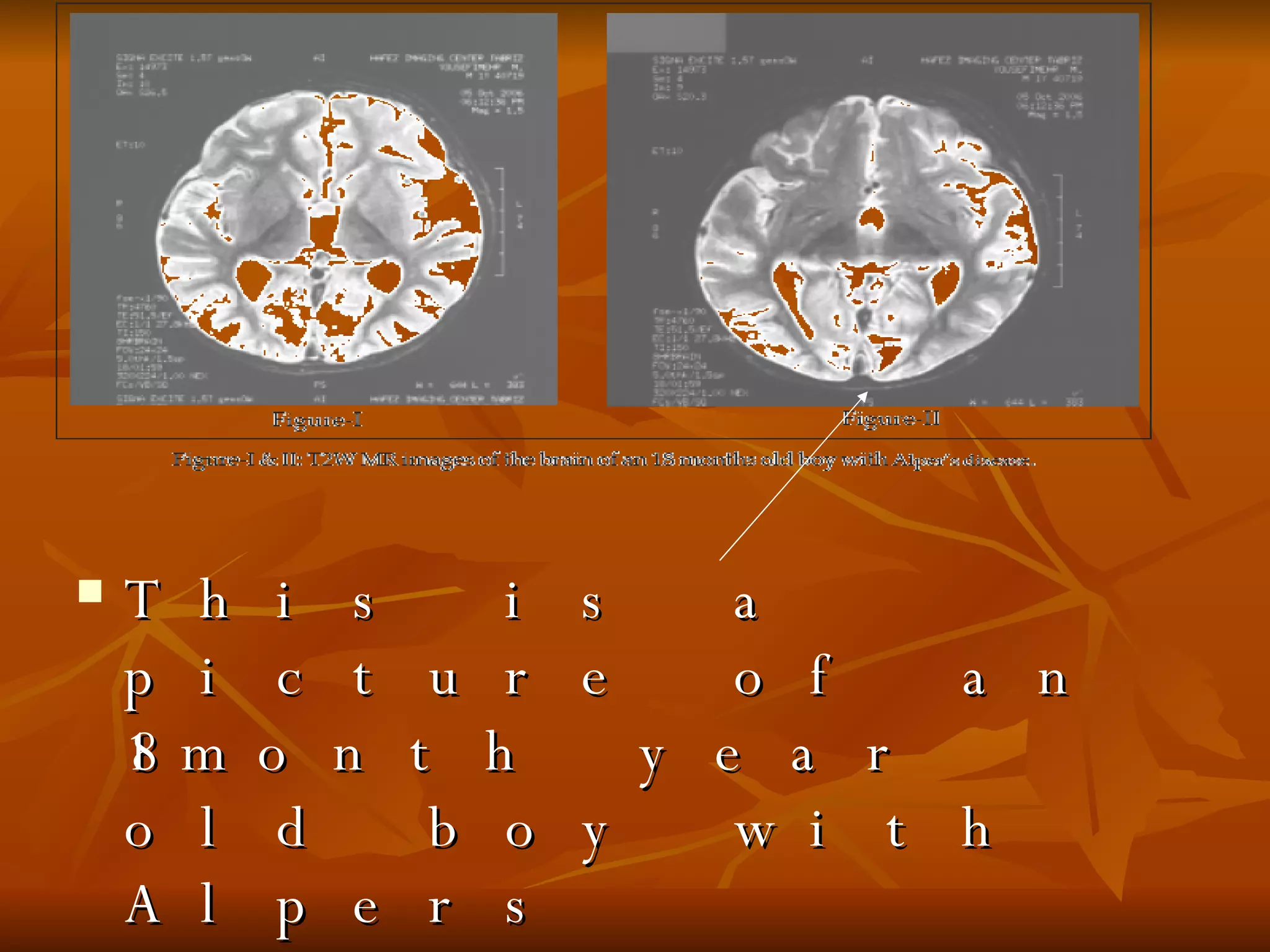 Alpers Syndrome!! | PPT
