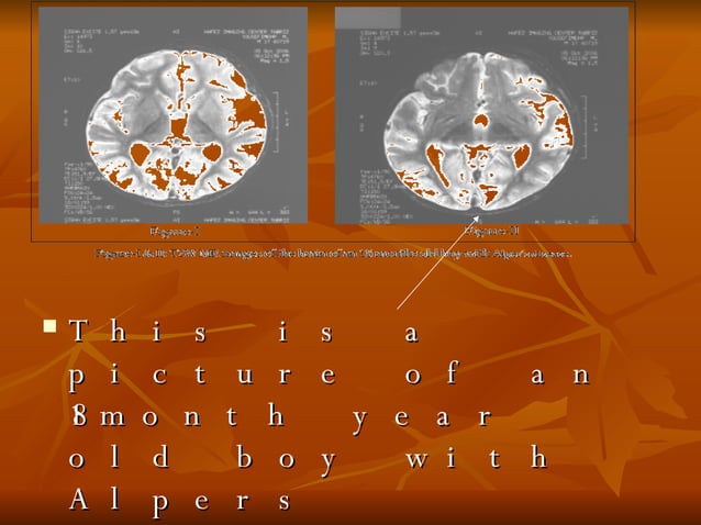 Alpers Syndrome!! | PPT