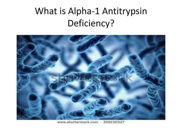 Alpha 1 antitrypsin deficiency | PPTX
